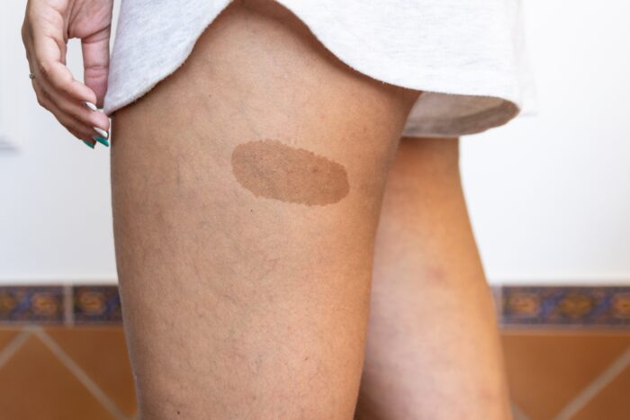 What’s the Best Laser Treatment for Pigmented Birthmarks? | Albuquerque